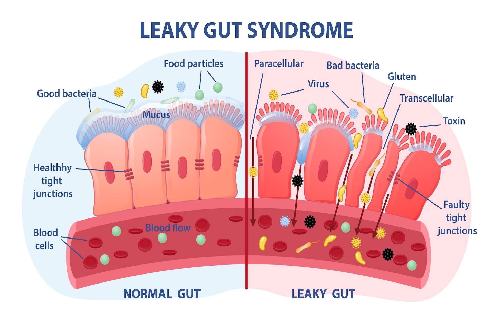 Are all autoimmune diseases caused by leaky gut?