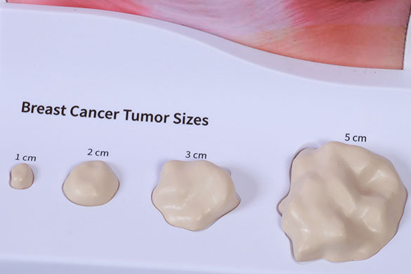 Are cancerous lumps movable or fixed?