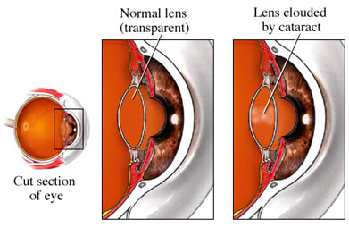 Are cataracts tumors?