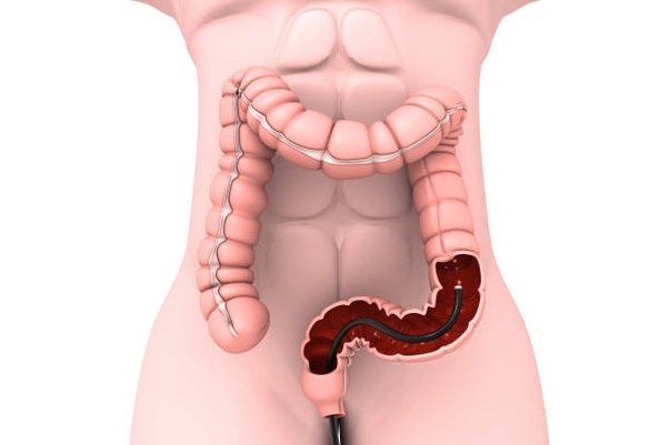 Are genitals exposed during a colonoscopy?