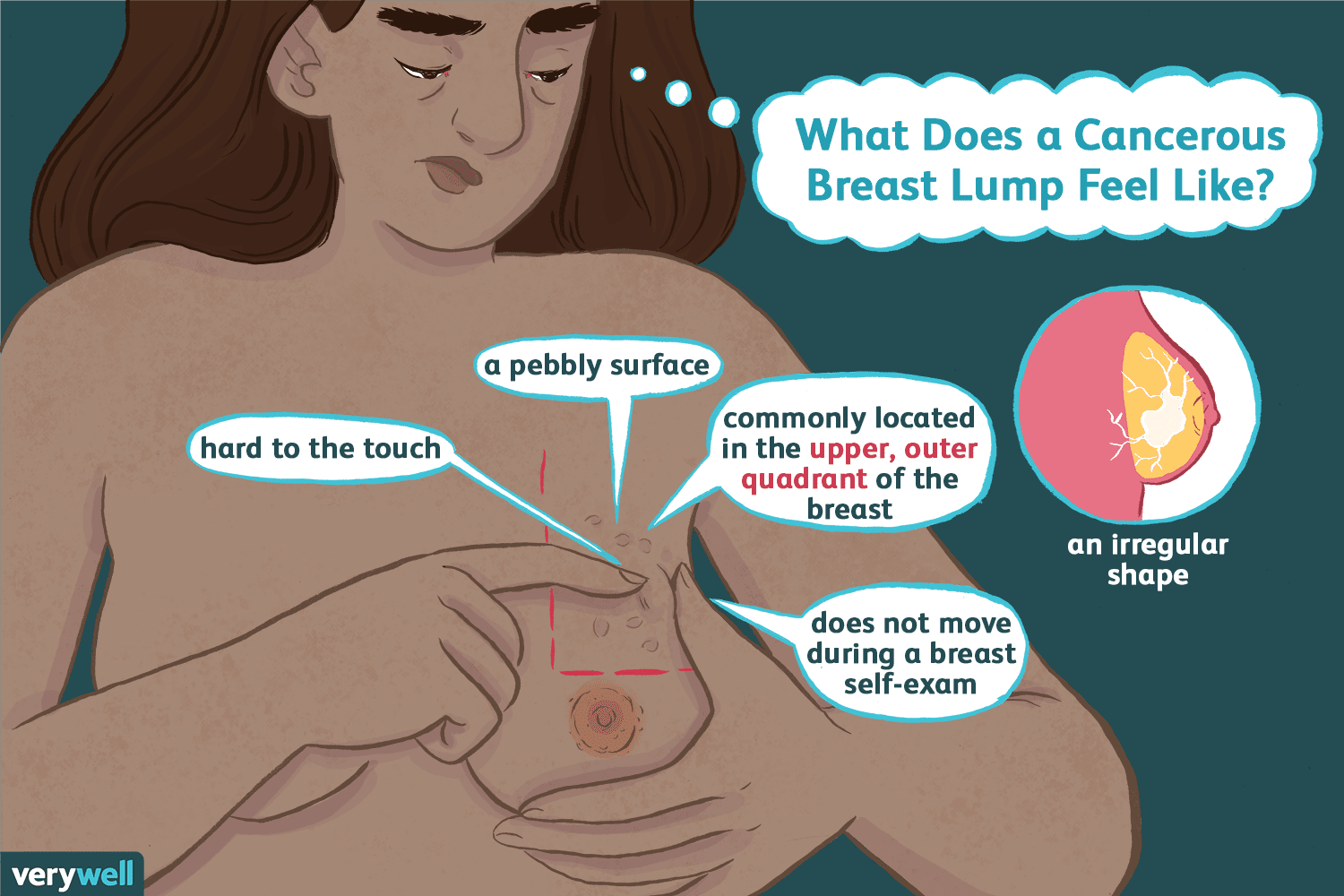 Are lumps usually cancer?