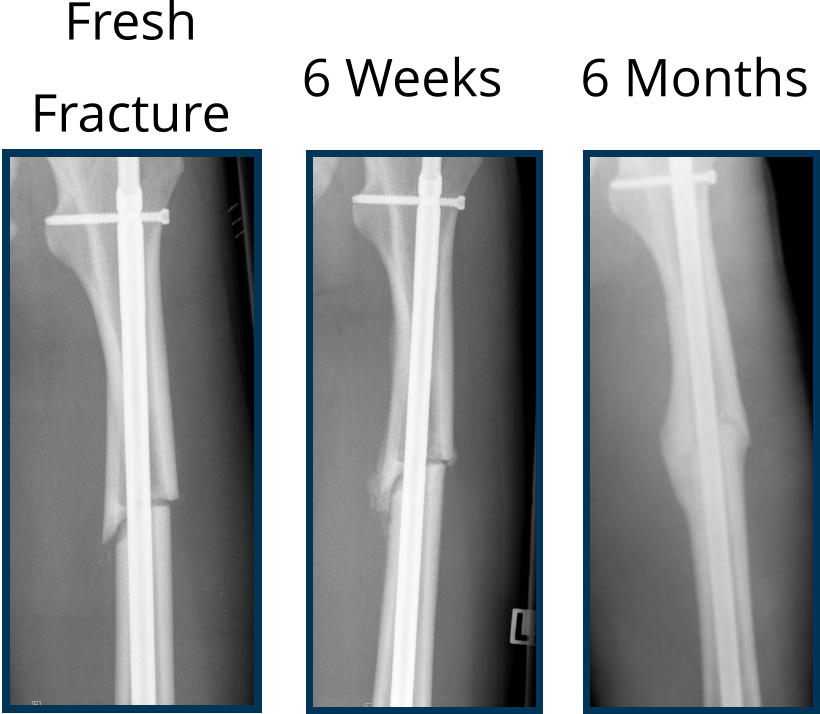 Can a bone heal in 1 week?