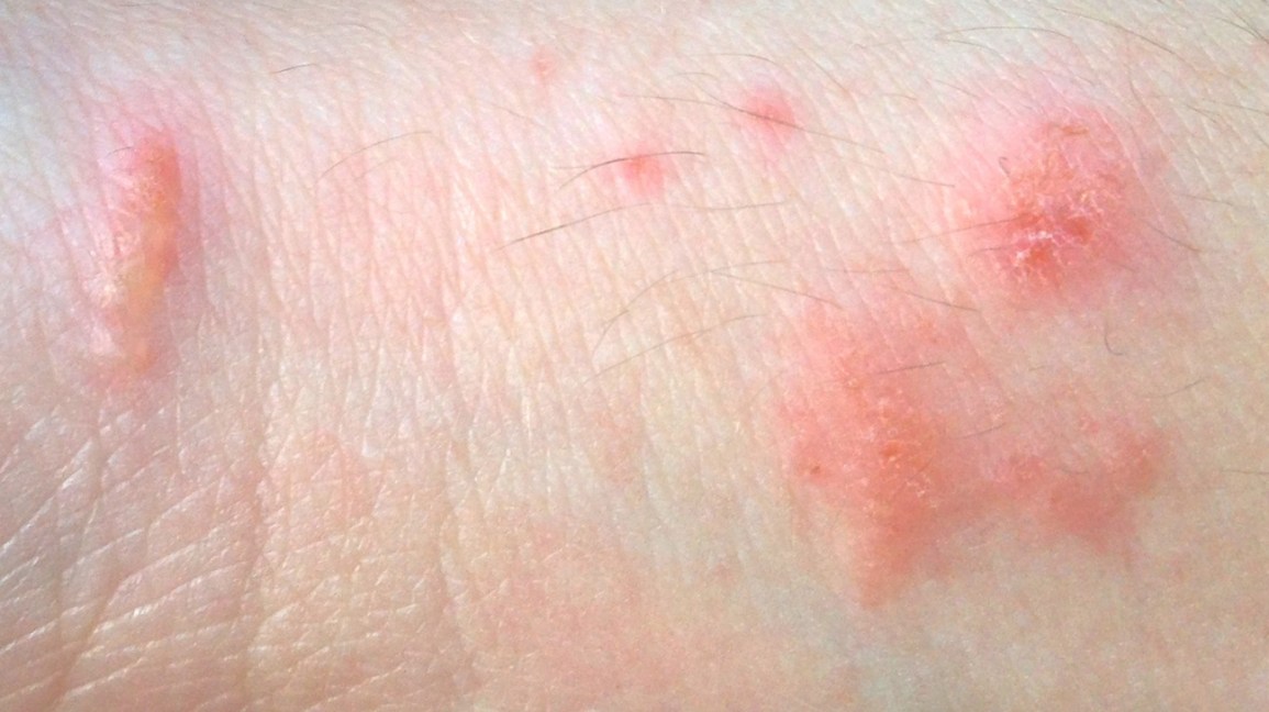 Can an allergic reaction occur a week later?