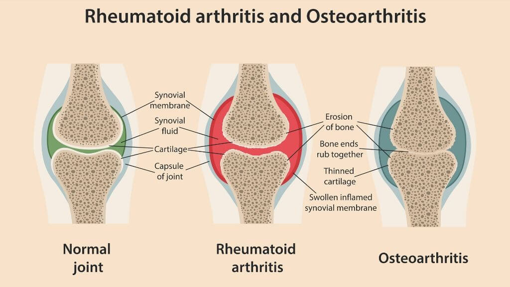 Can bone broth cause rheumatoid arthritis?