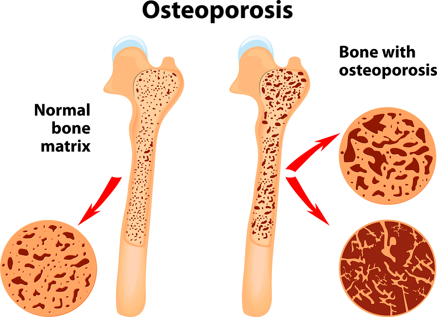 Can bone density loss be reversed?