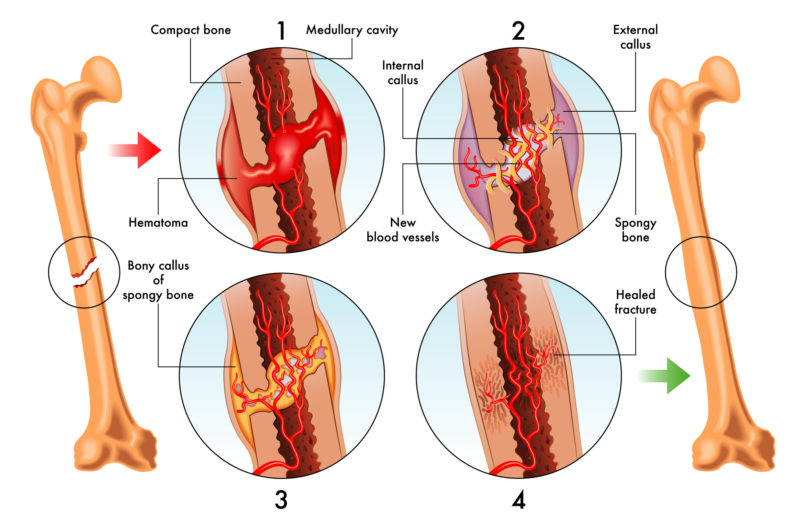 Can bones heal in days?