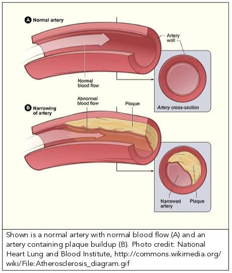 Can calcification in arteries be reversed?