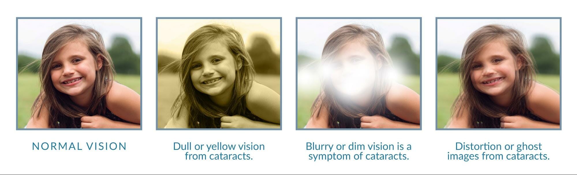 Can cataracts cause vision distortion?