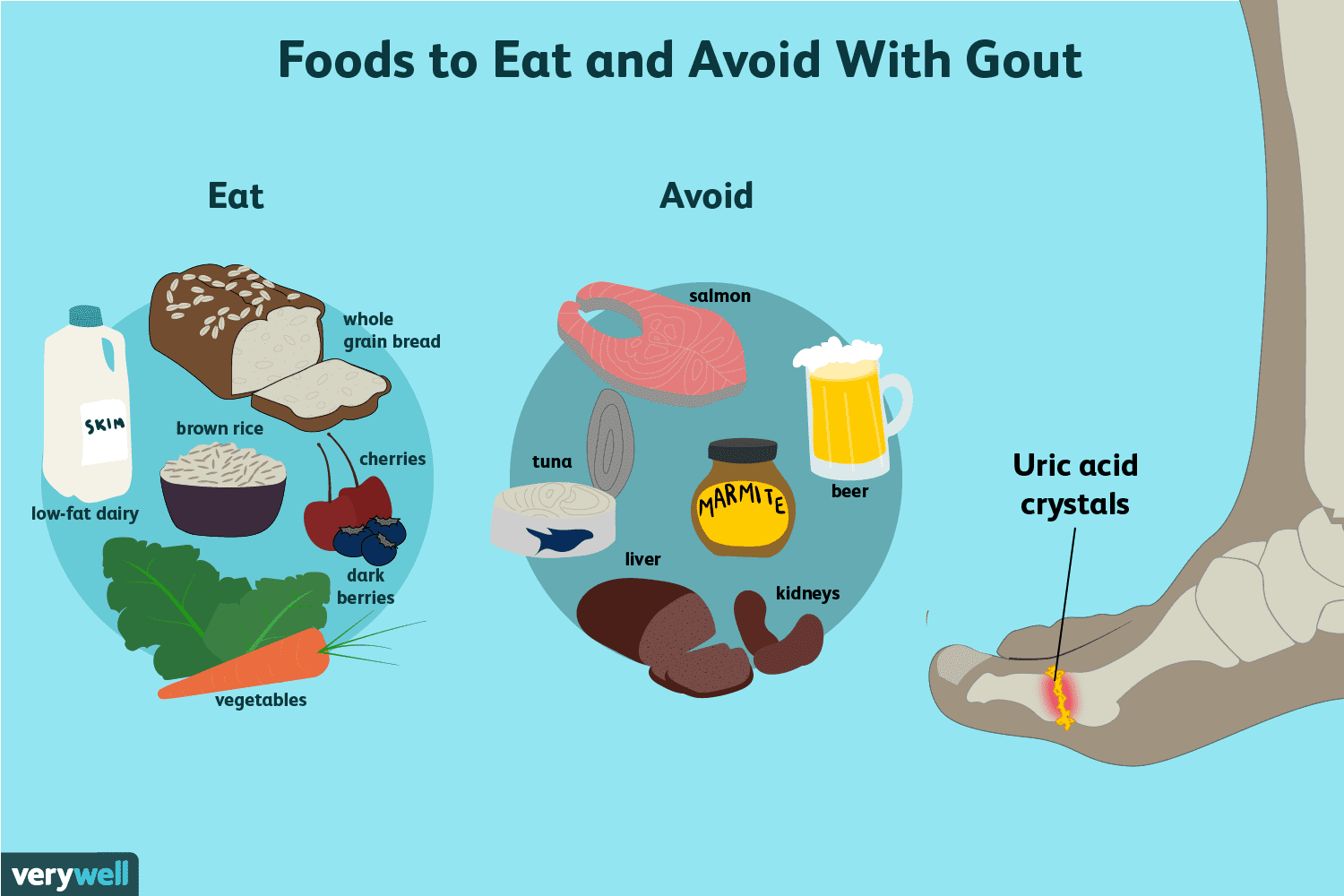 Can cheese cause gout flare up?