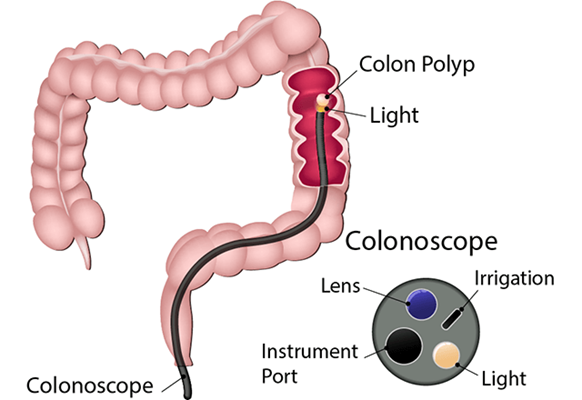 Can colonoscopy cause flatulence?