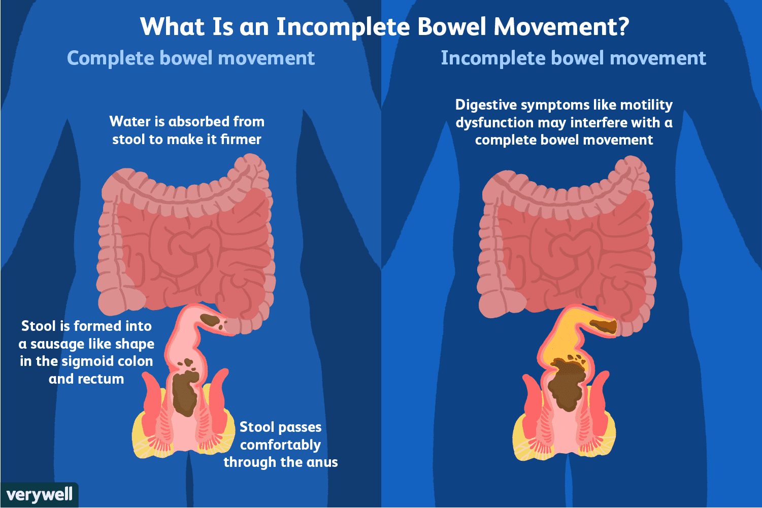 Can constipation cause frequent bowel movements?