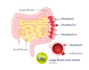 Can diverticulitis cause bloating and wind?
