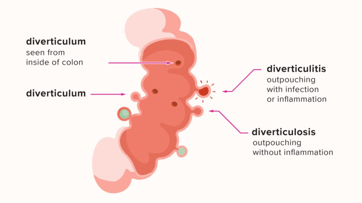 Can diverticulitis cause gas and bloating?