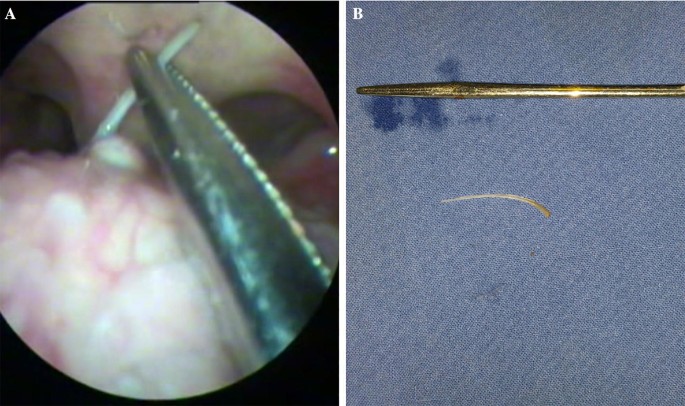 Can Fishbone cause throat infection?