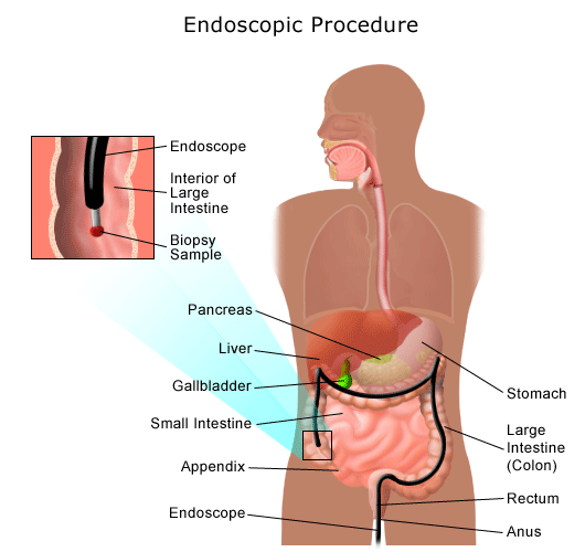 Can gas get stuck in intestines?