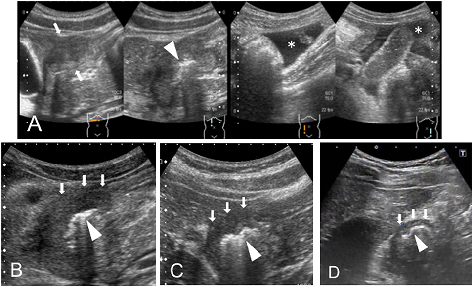 Can gastric ulcers be seen on ultrasound?