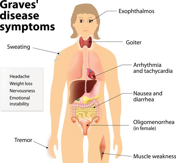 Can Graves disease be cured by diet?