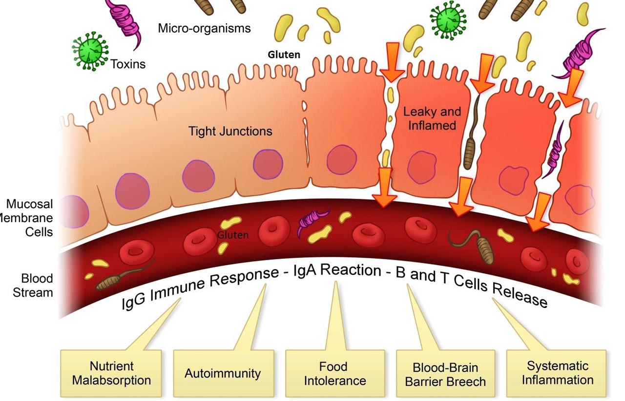 Can gut issues cause autoimmune disorders?