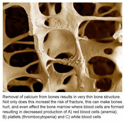 Can high calcium cause osteoporosis?
