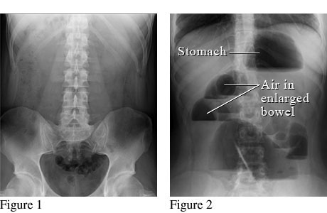 Can intestinal blockage be seen on xray?