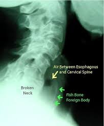 Can small fish bones be digested?