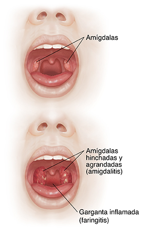 Can spicy food cause swollen tonsils?