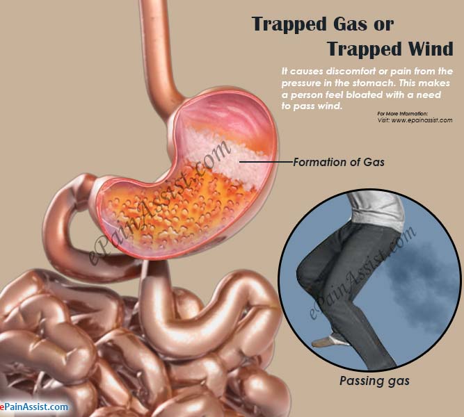 Can swallowing air cause trapped gas?