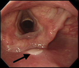 Can you burn your esophagus by swallowing hot food?