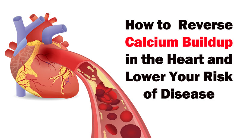 Can you reverse calcium buildup in arteries?