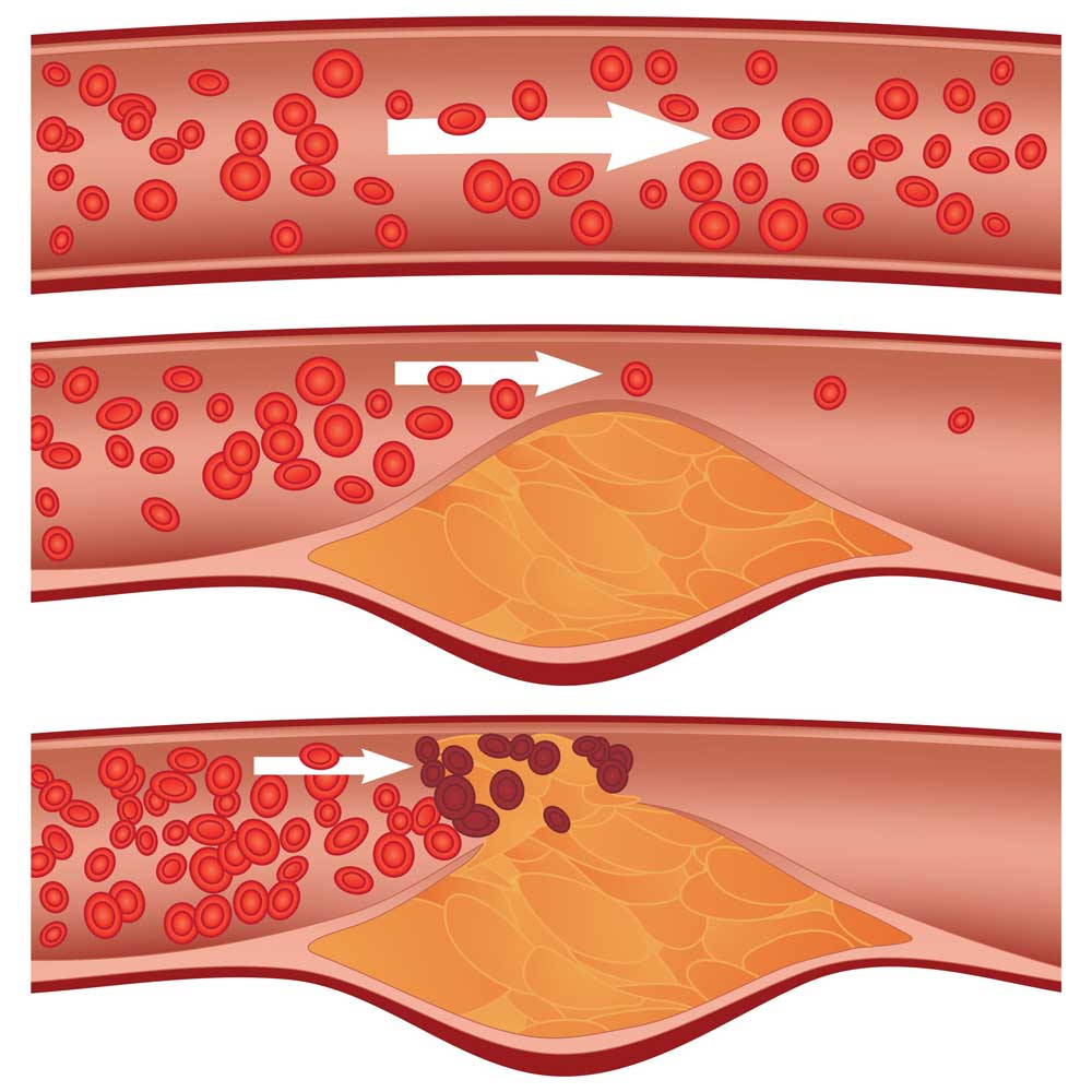 Can you reverse plaque buildup in your arteries?