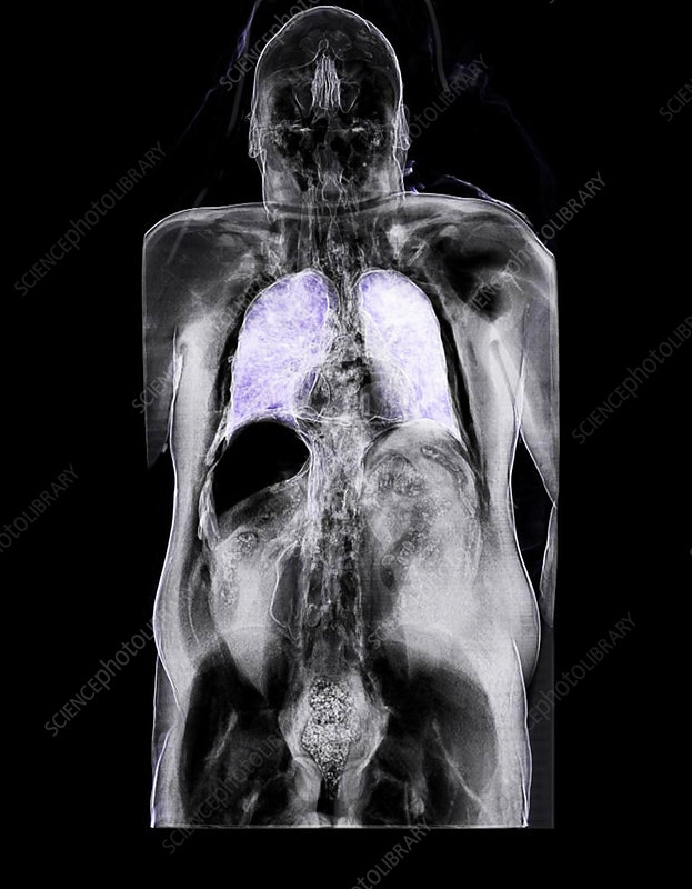 Can you see trapped gas in a CT scan?