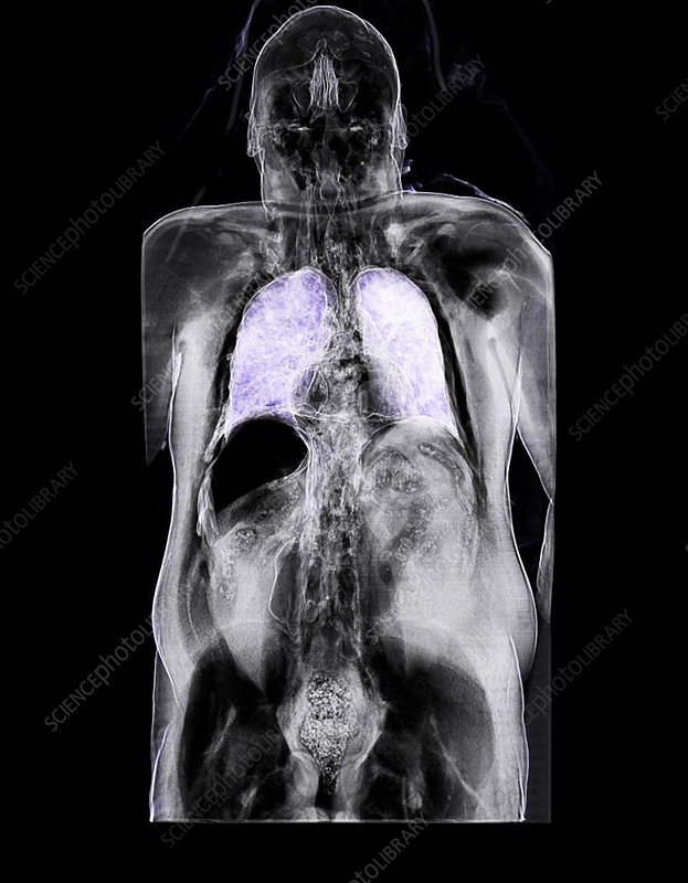 Can you see trapped gas on a CT scan?