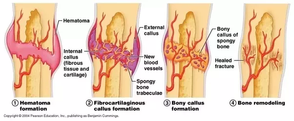 Do bones heal stronger after a break?