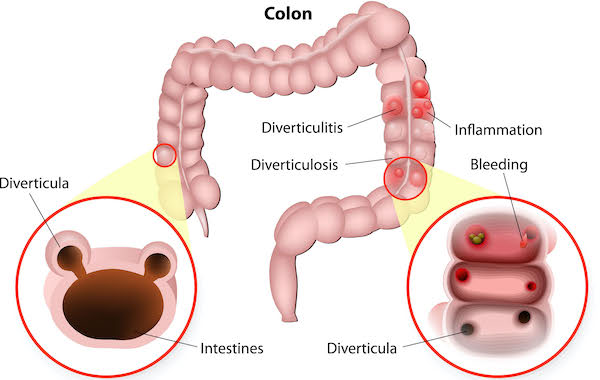 Do you get a lot of flatulence with diverticulitis?