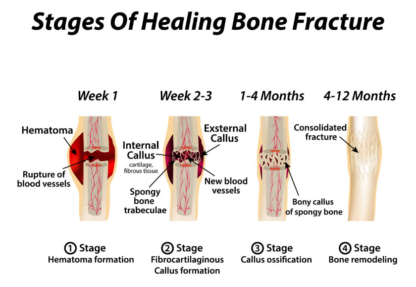Does a fracture ever fully heal?