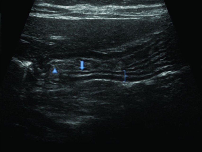 Does abdominal ultrasound show gastritis?