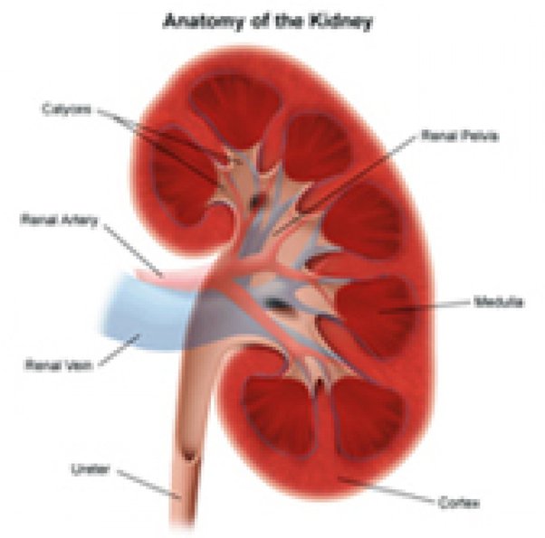 Does anything aggravate kidney stones?