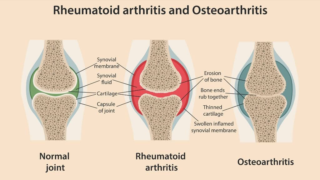 Does bone broth help with rheumatoid arthritis?