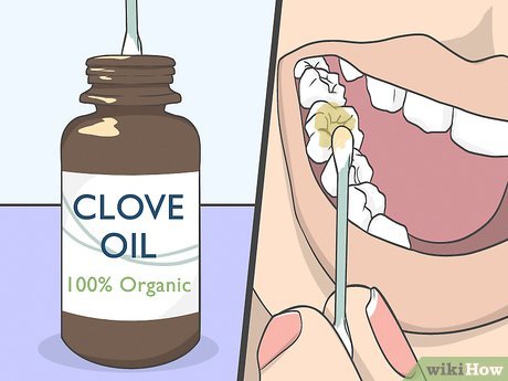 Does clove oil need to be diluted for toothache?