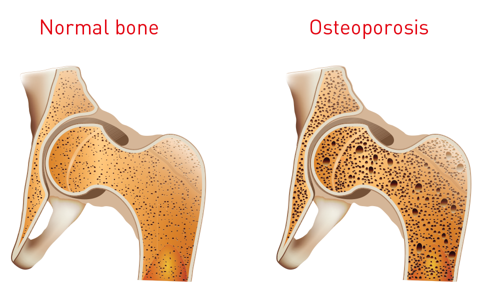 Does coffee affect bone density?