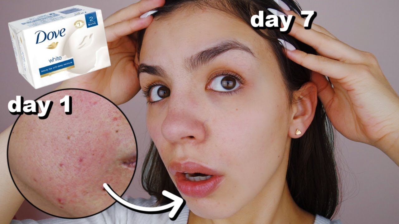 Does Dove soap cause acne?