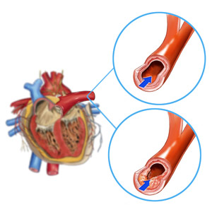 Does drinking a lot of water lower cholesterol?