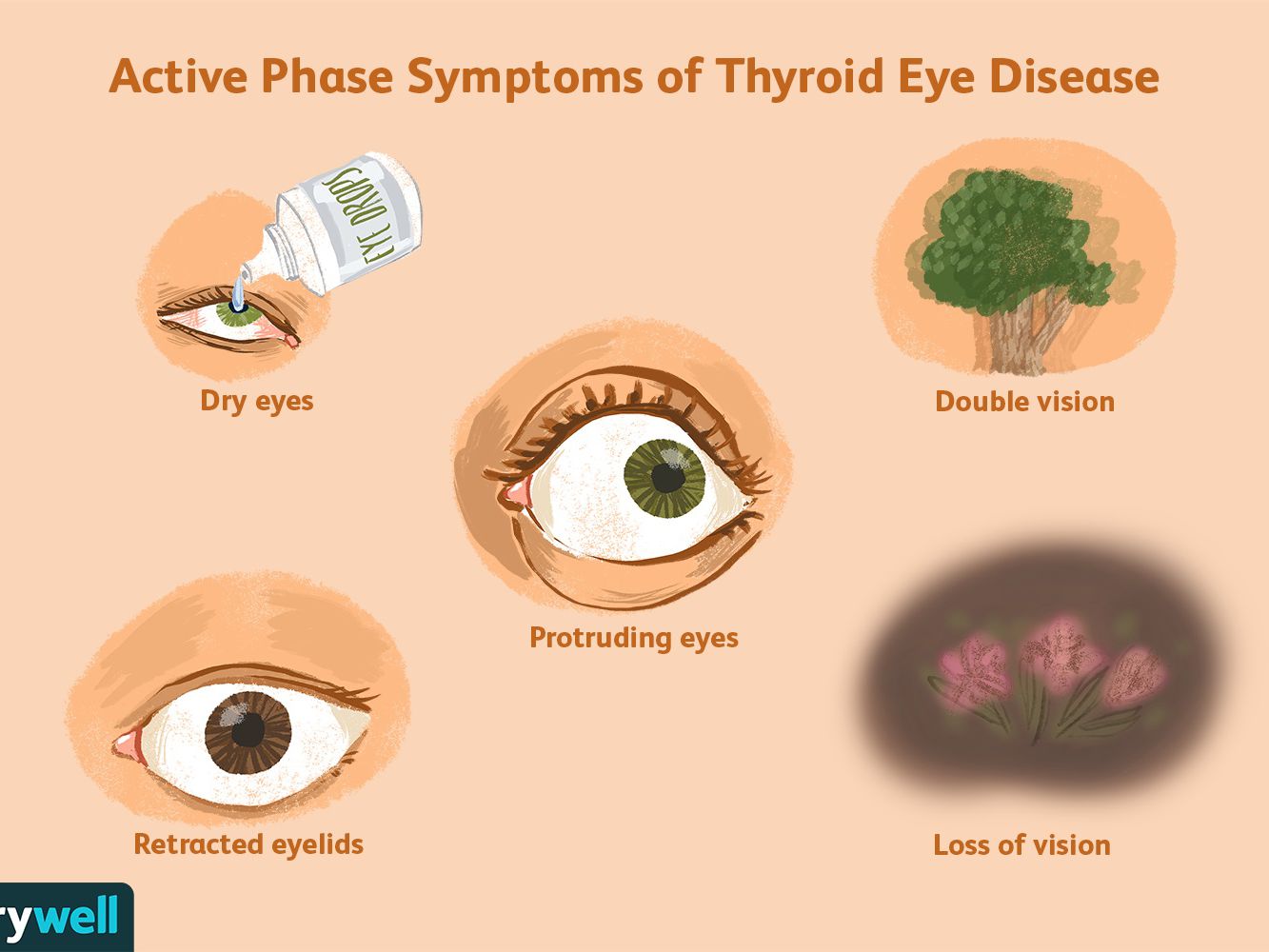 Does Graves disease shorten your life?