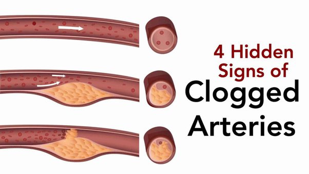 Does meat clog up your arteries?