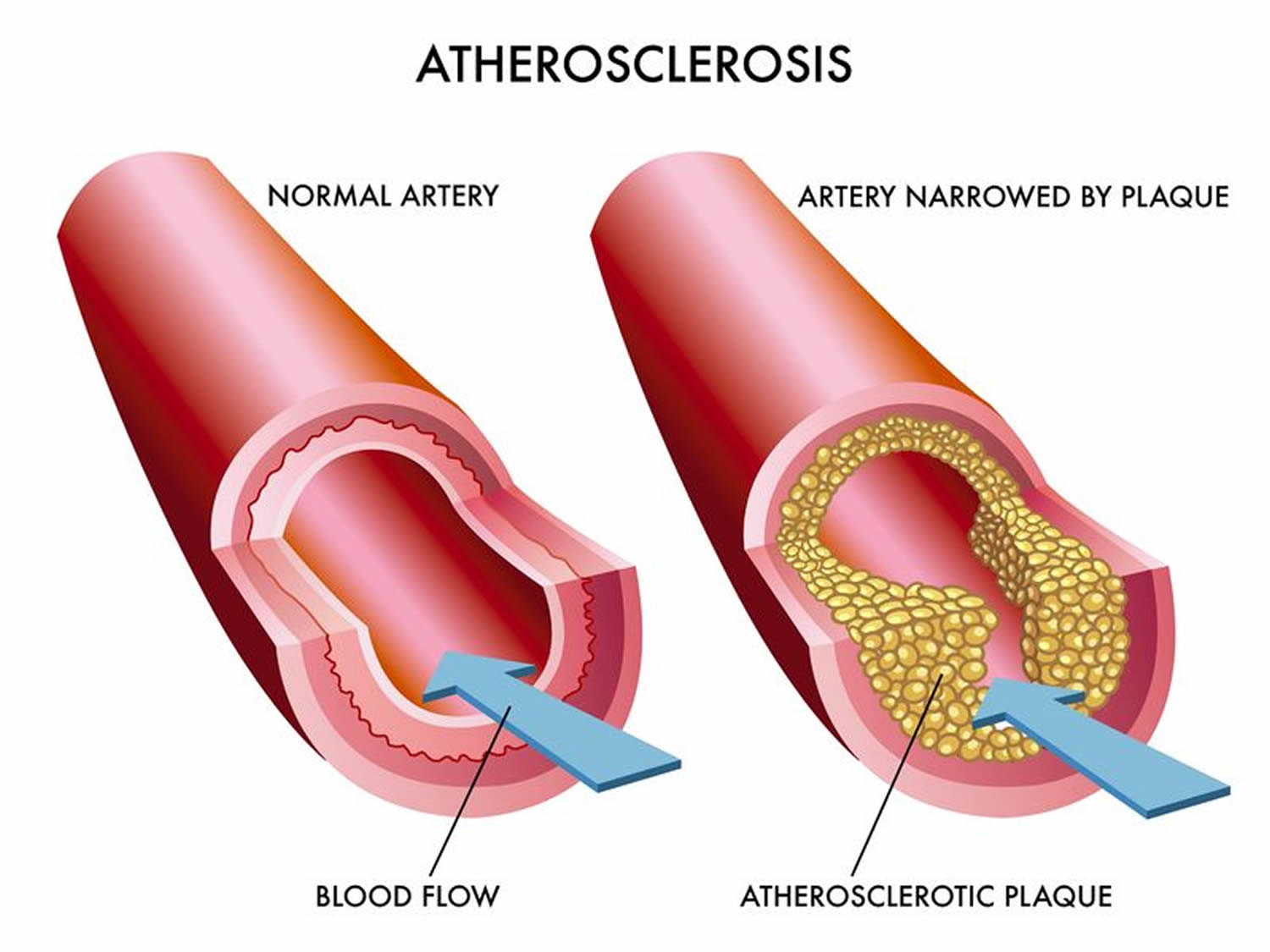 Does milk cause hardening of the arteries?
