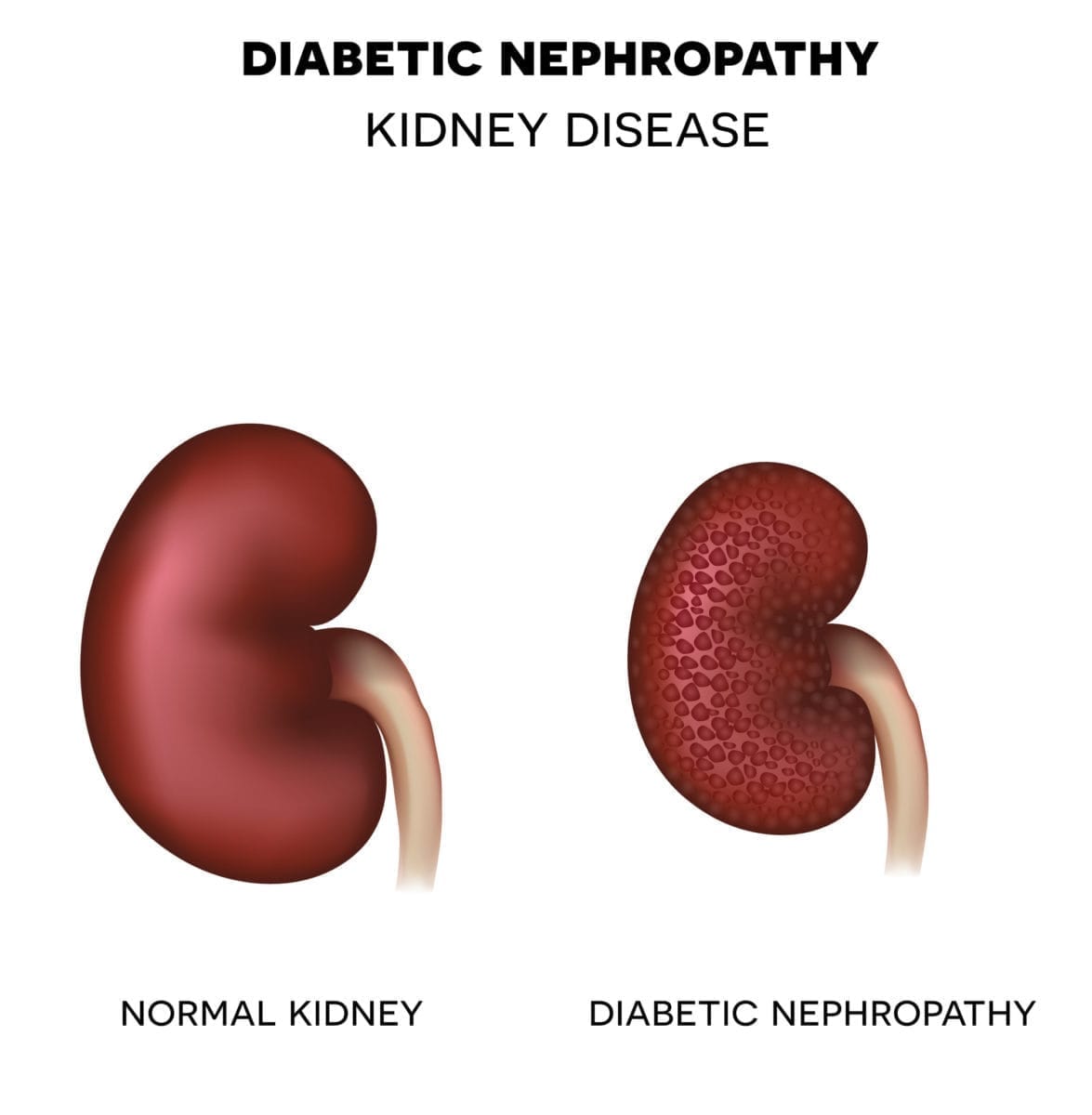 Does nephropathy go away?