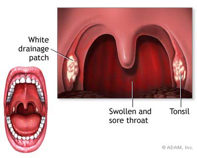 Does salt water make sore throat worse?