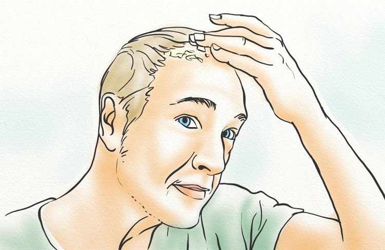 Does soya cause hair loss?