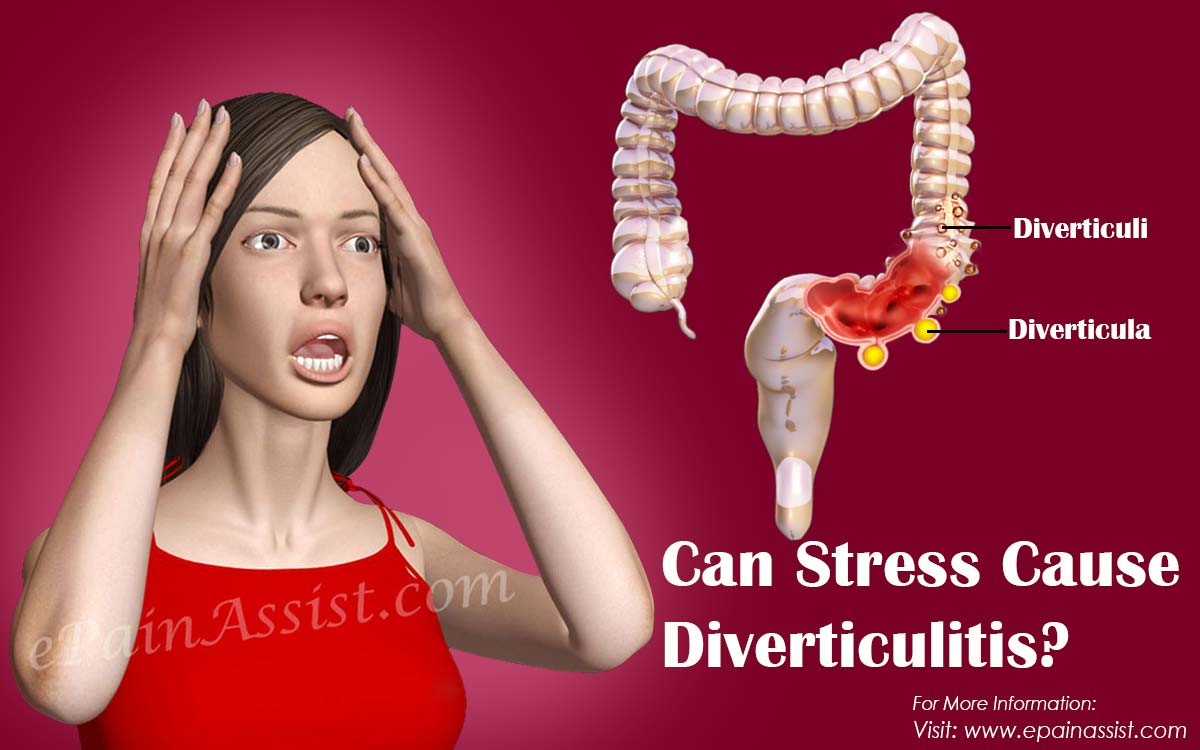 Does stress trigger diverticulitis?