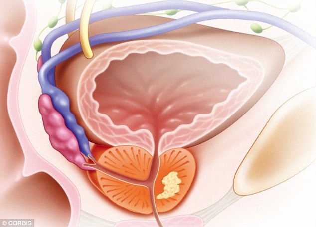 Does urine smell with prostate cancer?